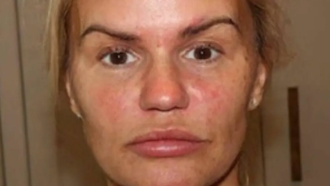 Kerry Katona reveals dramatic results after undergoing ‘facelift ...